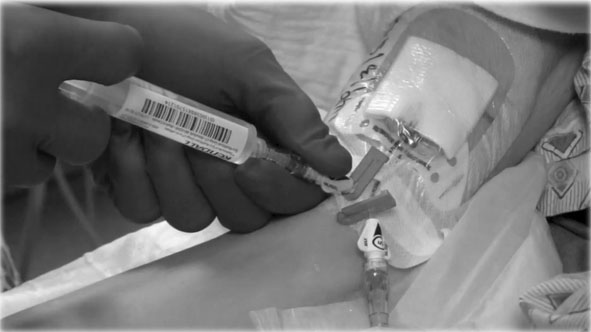 Repositioning of CVADs using high flow flushing technique – practice ...